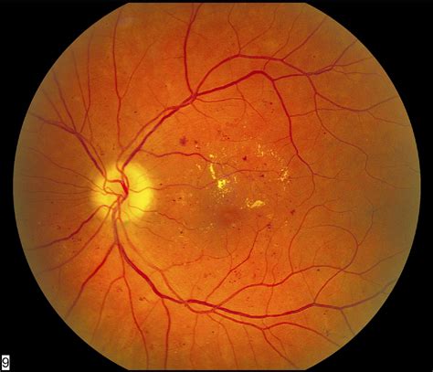 figure 1 from detection of diabetic retinopathy using