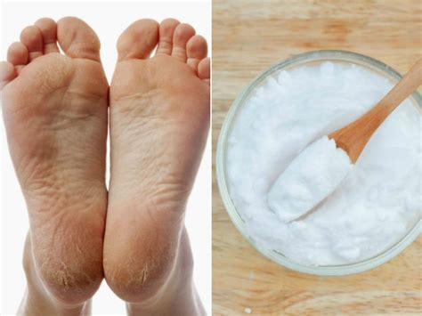 Aprende A Eliminar El Mal Olor En Los Pies Venezuela Noti America