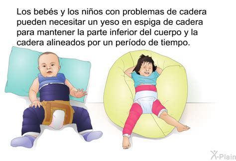 PatEdu Yeso En Espiga De Cadera