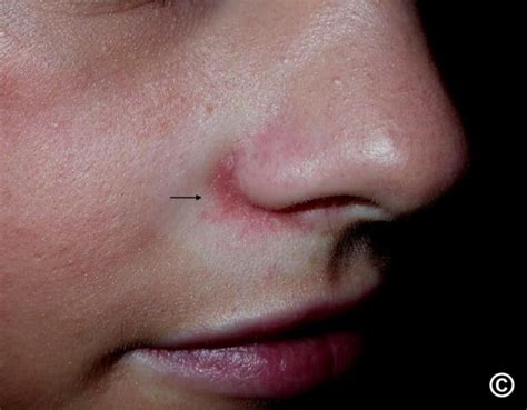 Dermatite Perioral O Que é Causas Sintomas E Tratamentos Blog Da Saúde