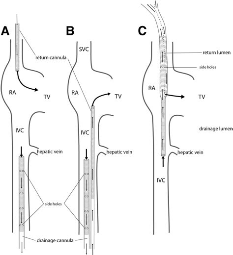 Figure 7 From Venovenous Extracorporeal Membrane Oxygenation In Adults