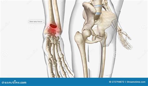 Distal Radius Fractures Are Among The Most Common Types Of Fractures