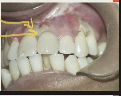 Dh 23 CHAPTER 8 OTHER CONDITIONS AFFECTING THE PERIODONTIUM Flashcards