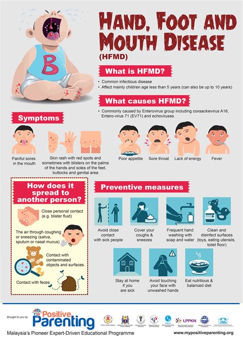Information On Hand Foot Mouth Disease Outlet Emergencydentistry