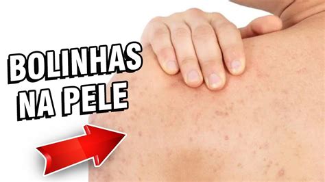 O que são as bolinhas na pele ceratose pilar YouTube