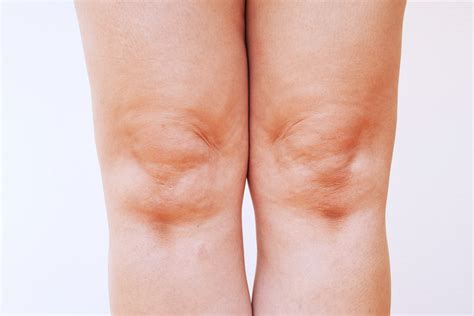 膝の痛みその原因は何膝痛にならないための予防法は 石井接骨院