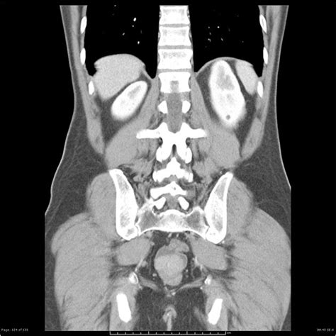Ct Scan Anus Colon Telegraph