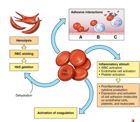 Sickle Cell Disease Flashcards Quizlet