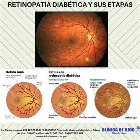 Retinopatía diabética y sus Etapas