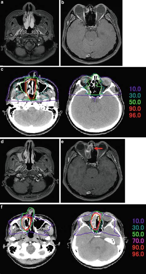 Malignant Melanoma Of The Head And Neck Radiology Key