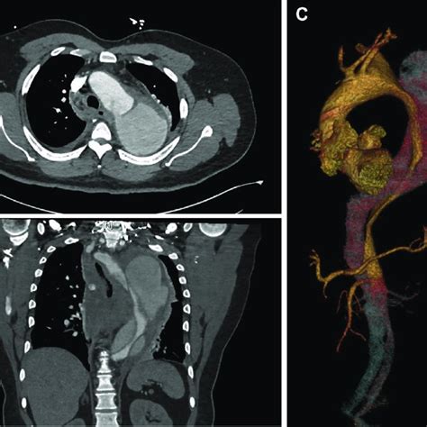 Preoperative Computed Tomography Angiogram CTA Demonstrating A 7 9 Cm