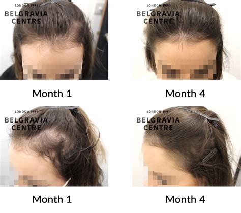 Hair Loss Success Story In Just Three Months My Hair Has Improved