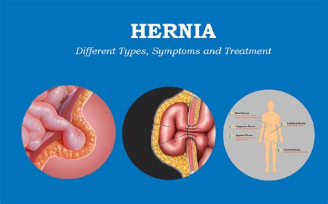 Types Of Hernias The Hernia Clinic