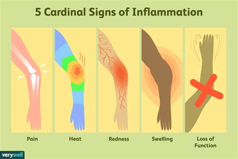 What Are The Cardinal Signs Of Inflammation