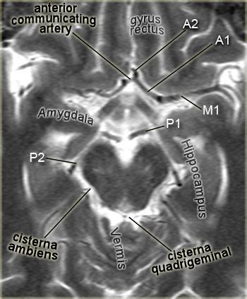 The Radiology Assistant Brain Anatomy Brain Anatomy Radiology Anatomy