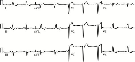 The Electrocardiographic Differential Diagnosis Of ST Segment