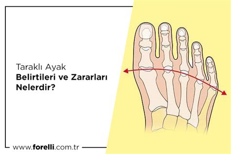 Taraklı Ayak Belirtileri ve Zararları Nelerdir Forelli