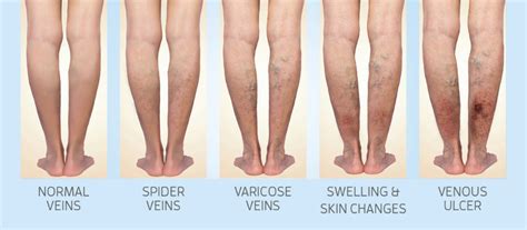 Chronic Venous Insufficiency CVI Washington Vascular