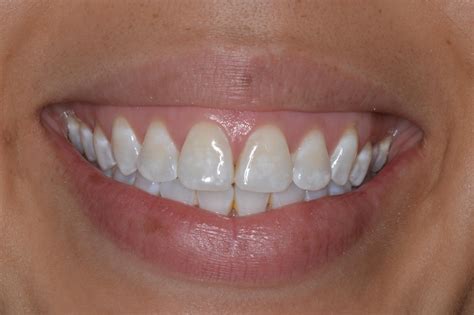 White Spots On Teeth Causes Treatment And Prevention 53 OFF