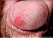 Venereal STD Test Clinic In Kerala India Venereal Herbal Treatment For