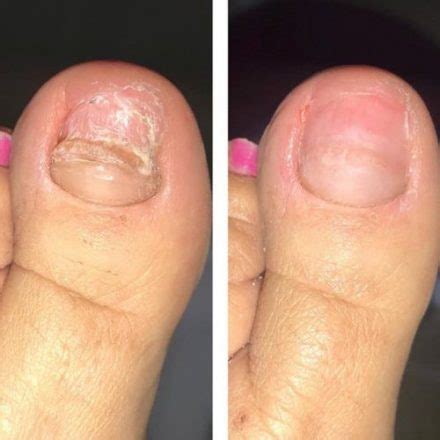 Reconstrucción Ungueal recupera tus uñas ya Fisiolution