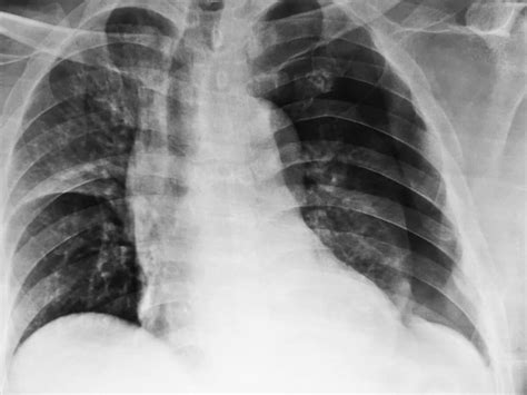 Pneumothorax Teachmesurgery