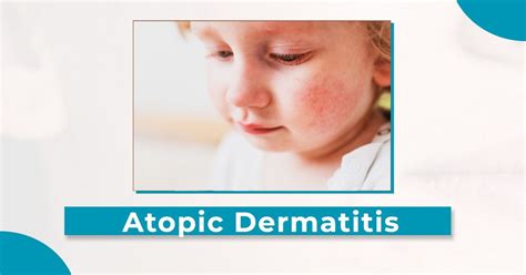 Atopic Dermatitis Causes Symptoms And Treatment Options