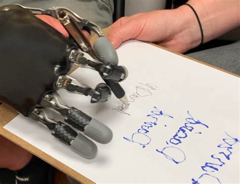 Hifi Interface Technology Prosthetic Socket Westcoast Brace Limb