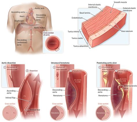 Aortic Dissection Type A And B Symptoms Causes Treatment