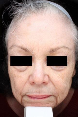 UltraClear Derm Laser Surgery
