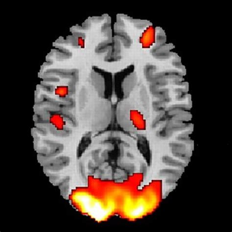 Brain Fmri Scan