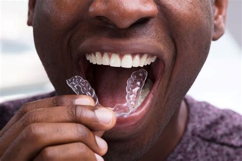 Clear Aligners In Carson City Absolute Dental Orthodontics