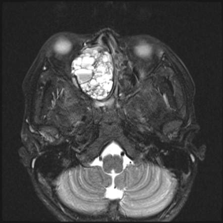 Aneurysmal Bone Cyst Radiology Reference Article Radiopaedia Org