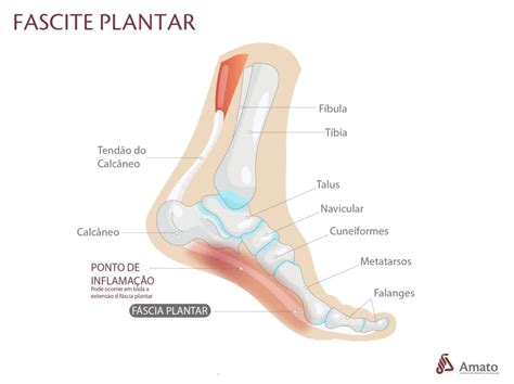 Sintomas Da Fascite Plantar Como Identificar Amato