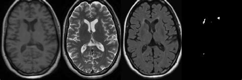 figure 1 from a robust expectation maximization algorithm for multiple sclerosis lesion