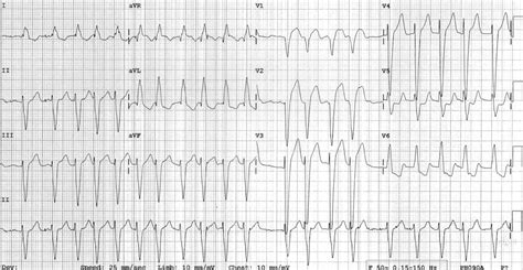 Dilated Cardiomyopathy DCM LITFL ECG Library Diagnosis