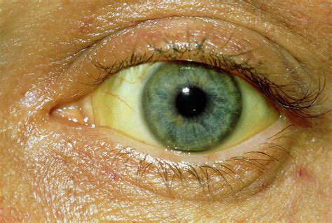 Yellow Staining Sclera Eye Diseases Liver Cirrhosis Hepatitis Bilirubin