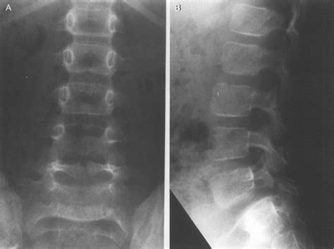 A Anteroposterior And B Lateral Radiographs Of The Lumbar Spine
