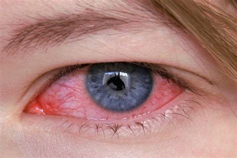 Conjuntivitis bacteriana síntomas cuánto dura y tratamiento Tua Saúde