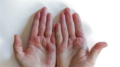 Eczema Exploring Its Different Faces Geomedics Pharma