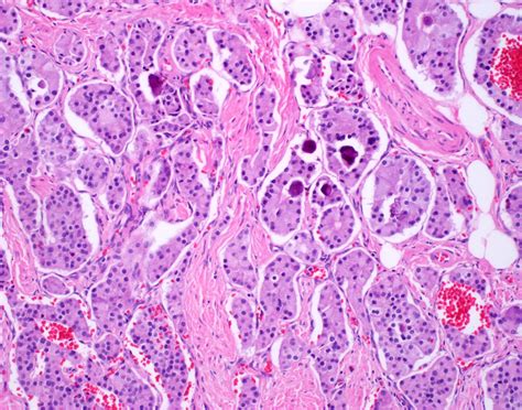 Pathology Outlines Neuroendocrine Tumor