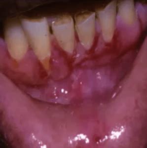 Pemphigus Vulgaris Diagnosis Treatment And Prognosis