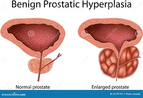 Benign Prostatic Hyperplasia Stock Image Image 25197741