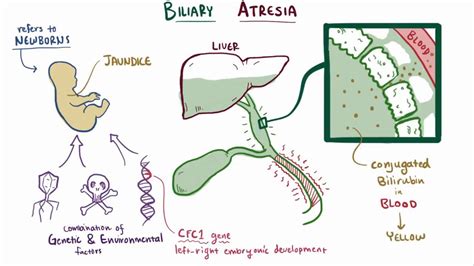 Biliary Atresia Video Anatomy Definition Function Osmosis