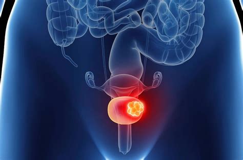 Cáncer de vejiga
