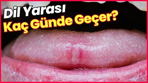 Dil yarası kaç günde geçer Şalgam suyu dil yarasına iyi gelir mi