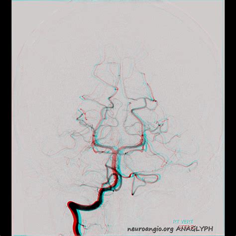 Posterior Cerebral Artery Neuroangio Org