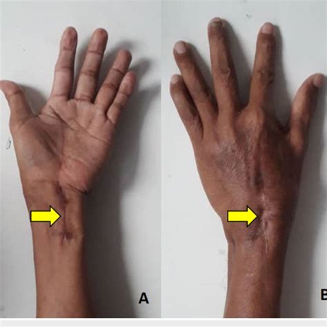Clinical Picture Of The Left Wrist After One Year A Volar Aspect Of