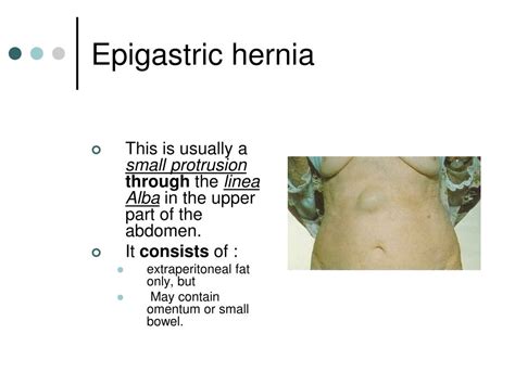 PPT HERNIAS PowerPoint Presentation ID 679255