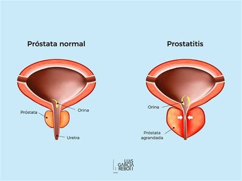 Prostatitis Causas Diagn Stico Tratamiento Y Prevenci N Hombres
